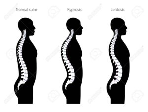 Understanding Kyphosis: Insights from Dr. Shashidhar B K - Bangalore ...