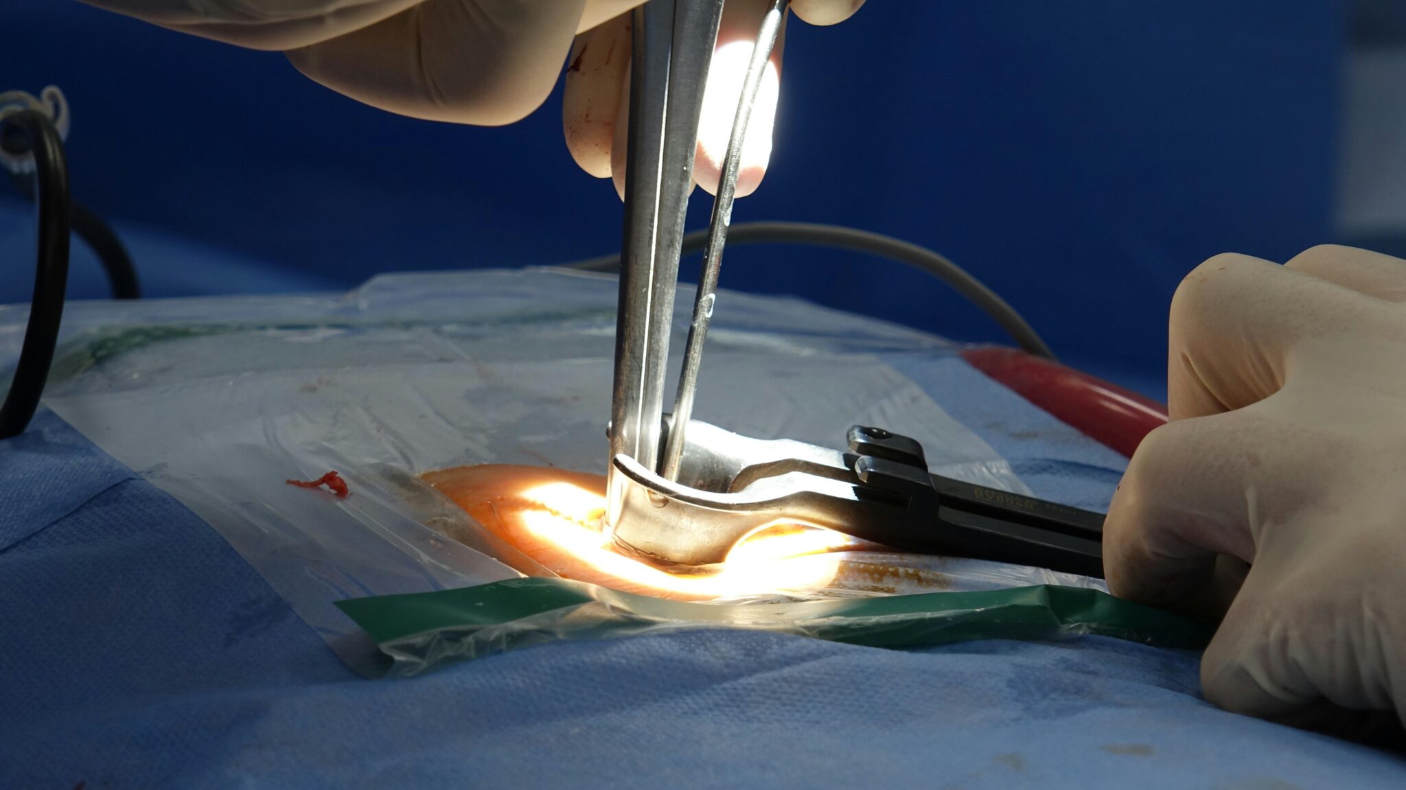 Minimally Invasive Spine Surgery vs. Conventional Spine Surgery ...